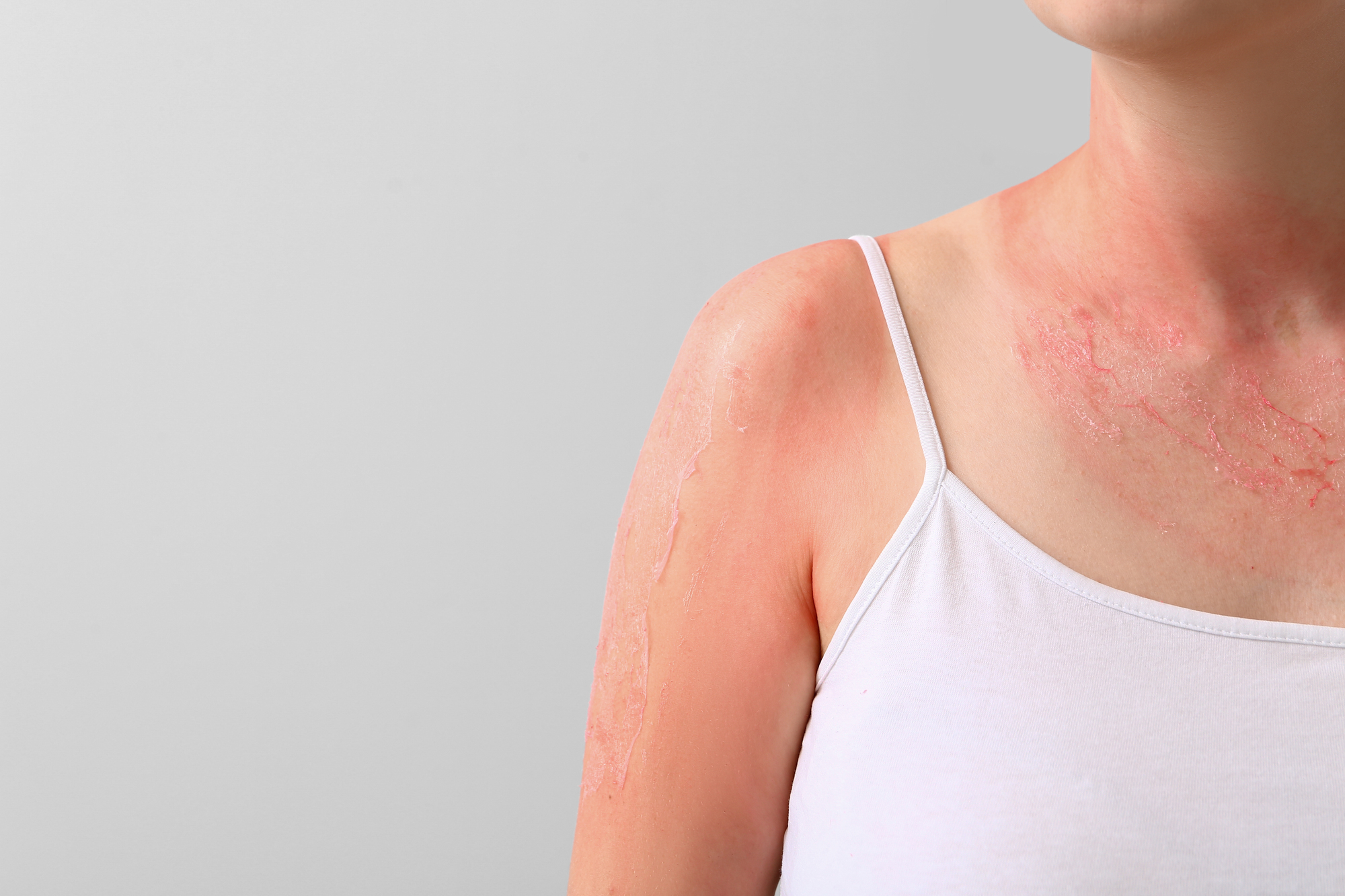 Alergie na slunce u dětí – jak se projevuje a jak ji zmírnit? | Kočárkem.cz